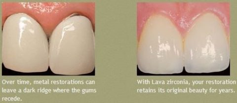 ZIRCONIA CROWNS – DENTAL IMPLANT SPECIALITY CENTRE